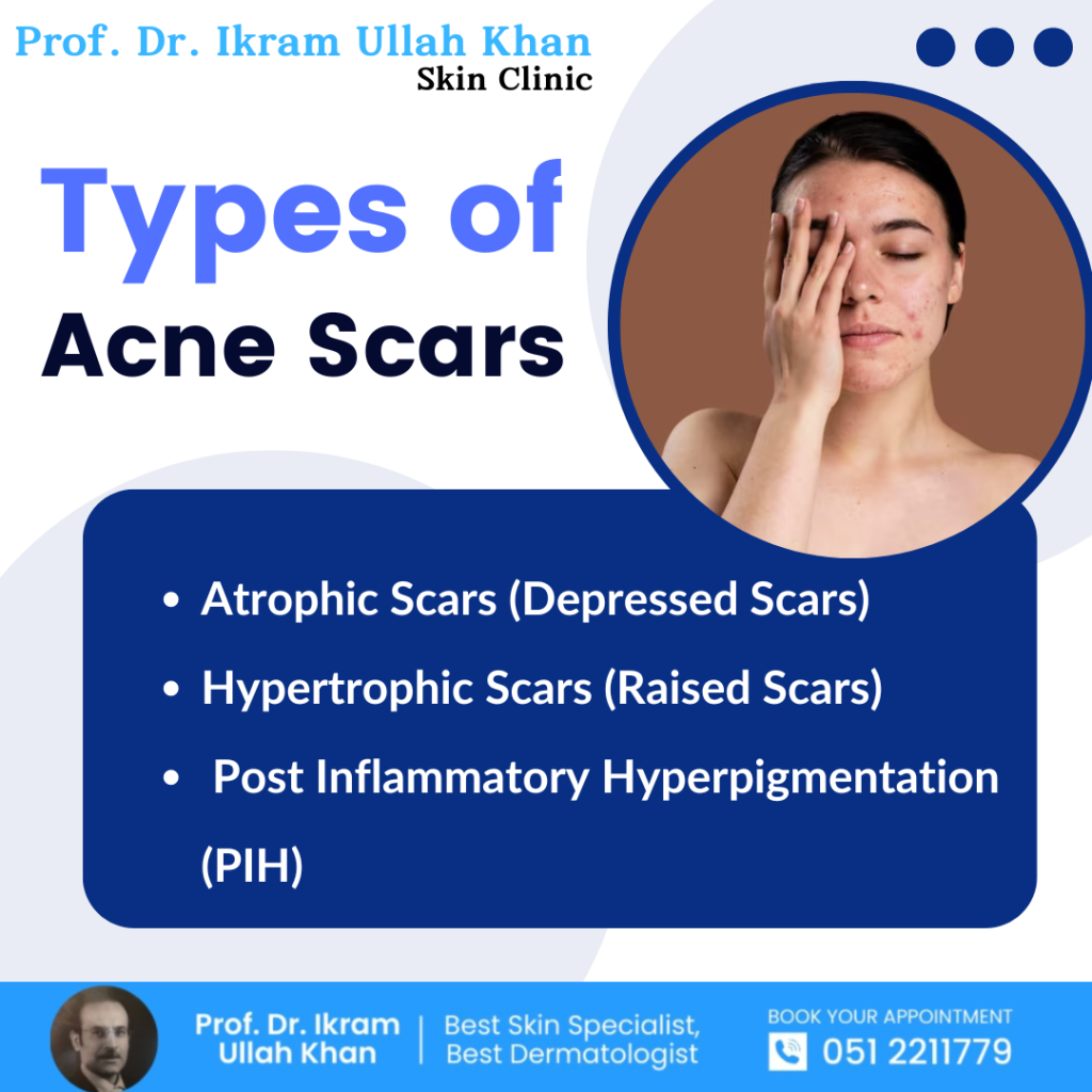 Acne Scars: Causes, Types, Home Remedies, Treatments